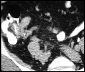 LearningRadiology.com-Imaging in PID, US and CT,pelvic,inflammatory ...