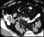 LearningRadiology.com-Imaging in PID, US and CT,pelvic,inflammatory ...