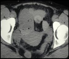 LearningRadiology.com-Imaging in PID, US and CT,pelvic,inflammatory ...