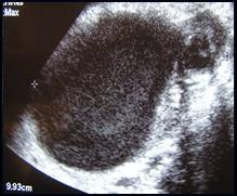 LearningRadiology.com-Imaging in PID, US and CT,pelvic,inflammatory ...