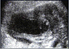 LearningRadiology.com-Imaging in PID, US and CT,pelvic,inflammatory ...