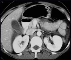 LearningRadiology.com-Imaging in PID, US and CT,pelvic,inflammatory ...