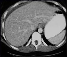 LearningRadiology.com-Imaging in PID, US and CT,pelvic,inflammatory ...