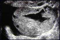 LearningRadiology.com-Imaging in PID, US and CT,pelvic,inflammatory ...