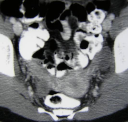 LearningRadiology.com-Imaging in PID, US and CT,pelvic,inflammatory ...