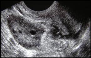 LearningRadiology.com-Imaging in PID, US and CT,pelvic,inflammatory ...