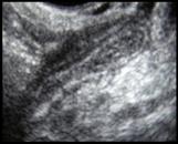 LearningRadiology.com-Imaging in PID, US and CT,pelvic,inflammatory ...