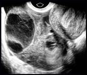 LearningRadiology.com-Imaging in PID, US and CT,pelvic,inflammatory ...