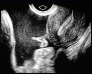 LearningRadiology.com-Imaging in PID, US and CT,pelvic,inflammatory ...