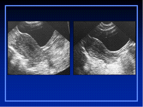 LearningRadiology.com-Imaging in PID, US and CT,pelvic,inflammatory ...