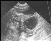 LearningRadiology.com-Imaging in PID, US and CT,pelvic,inflammatory ...