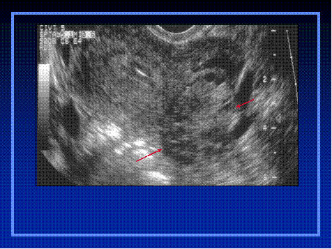 LearningRadiology.com-Imaging in PID, US and CT,pelvic,inflammatory ...