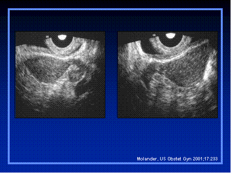 LearningRadiology.com-Imaging in PID, US and CT,pelvic,inflammatory ...