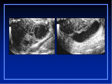 LearningRadiology.com-Imaging in PID, US and CT,pelvic,inflammatory ...