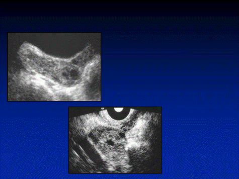 LearningRadiology.com-Imaging in PID, US and CT,pelvic,inflammatory ...