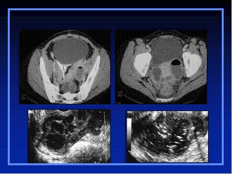 LearningRadiology.com-Imaging in PID, US and CT,pelvic,inflammatory ...