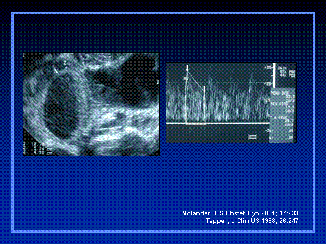 LearningRadiology.com-Imaging in PID, US and CT,pelvic,inflammatory ...