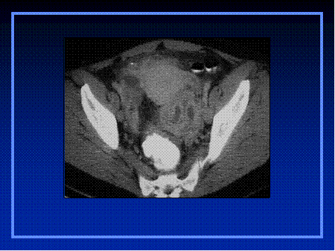 LearningRadiology.com-Imaging in PID, US and CT,pelvic,inflammatory ...