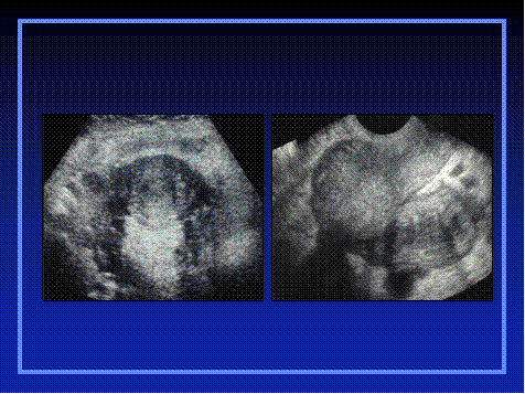 LearningRadiology.com-Imaging in PID, US and CT,pelvic,inflammatory ...