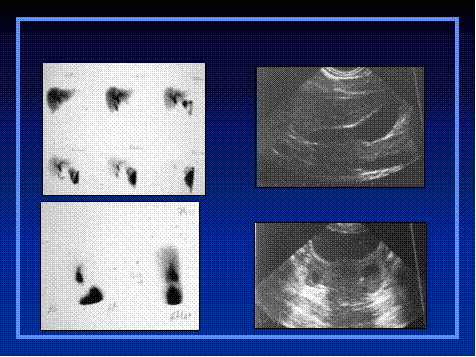 LearningRadiology.com-Imaging in PID, US and CT,pelvic,inflammatory ...