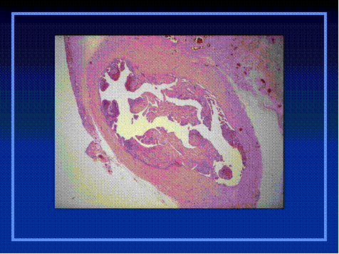 LearningRadiology.com-Imaging in PID, US and CT,pelvic,inflammatory ...