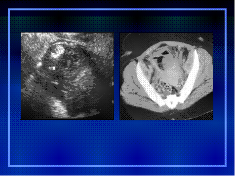LearningRadiology.com-Imaging in PID, US and CT,pelvic,inflammatory ...