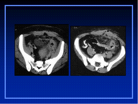 LearningRadiology.com-Imaging in PID, US and CT,pelvic,inflammatory ...