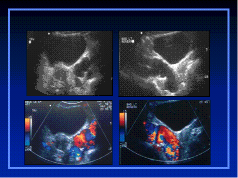LearningRadiology.com-Imaging in PID, US and CT,pelvic,inflammatory ...