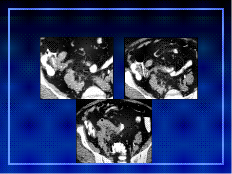 LearningRadiology.com-Imaging in PID, US and CT,pelvic,inflammatory ...