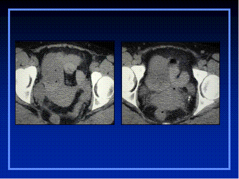 LearningRadiology.com-Imaging in PID, US and CT,pelvic,inflammatory ...