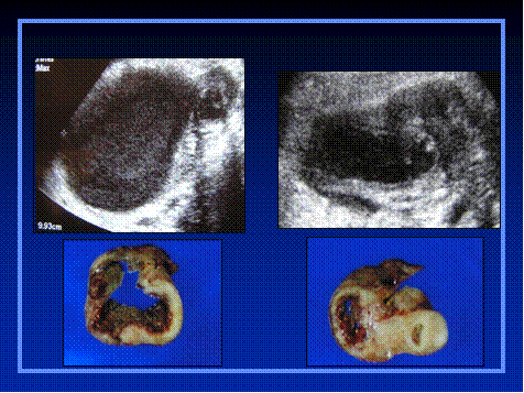 LearningRadiology.com-Imaging in PID, US and CT,pelvic,inflammatory ...