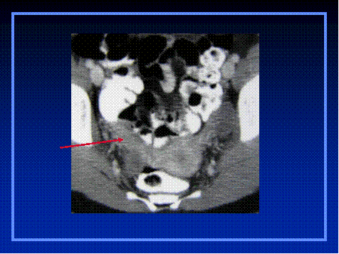 LearningRadiology.com-Imaging in PID, US and CT,pelvic,inflammatory ...