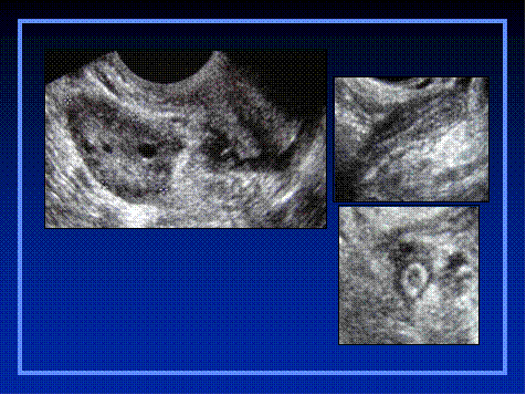 LearningRadiology.com-Imaging in PID, US and CT,pelvic,inflammatory ...