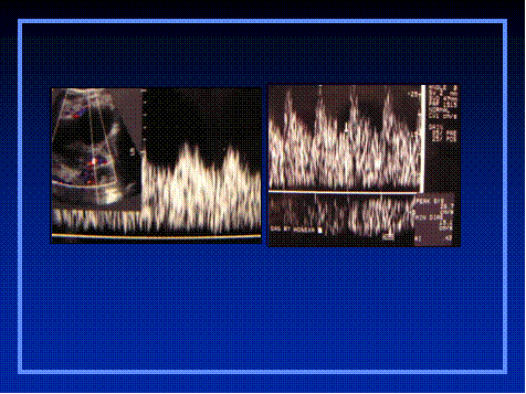 LearningRadiology.com-Imaging in PID, US and CT,pelvic,inflammatory ...