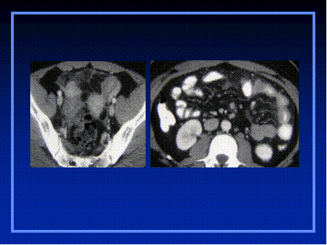 LearningRadiology.com-Imaging in PID, US and CT,pelvic,inflammatory ...