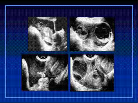 LearningRadiology.com-Imaging in PID, US and CT,pelvic,inflammatory ...