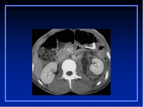 LearningRadiology-Retroperitoneal Spaces Anatomy and Pathology of the ...