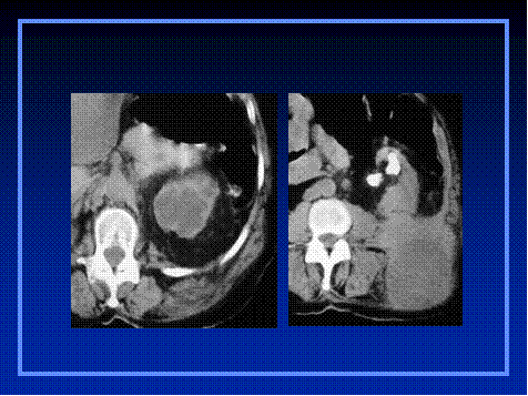 LearningRadiology-Retroperitoneal Spaces Anatomy and Pathology of the ...