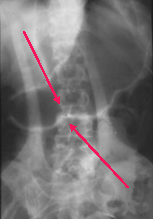 LearningRadiology-Recognizing Free Air