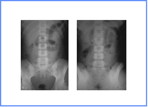 LearningRadiology-Recognizing Obstruction