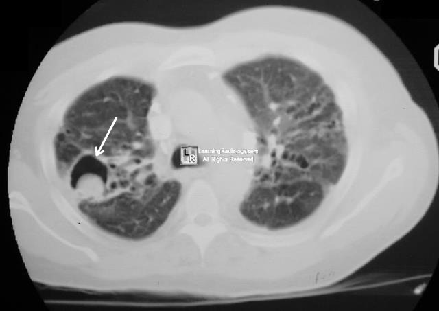 Welcome to LearningRadiology - radiology, radiologic, imaging, signs ...