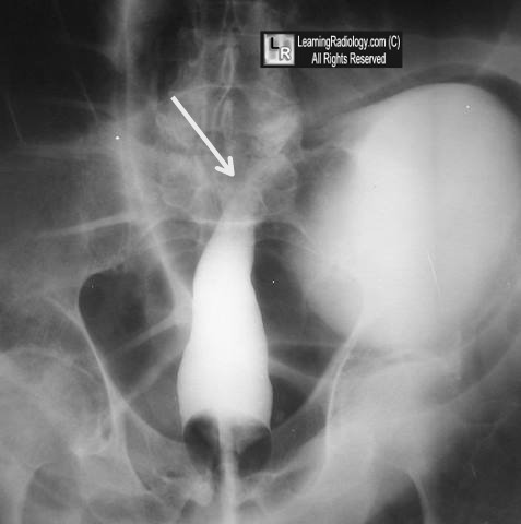Sigmoid Volvulus Omega Sign