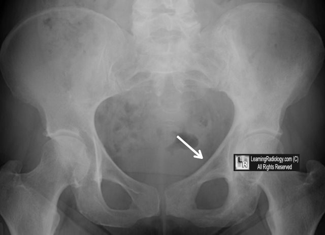 Welcome to LearningRadiology - radiology, radiologic, imaging, signs ...