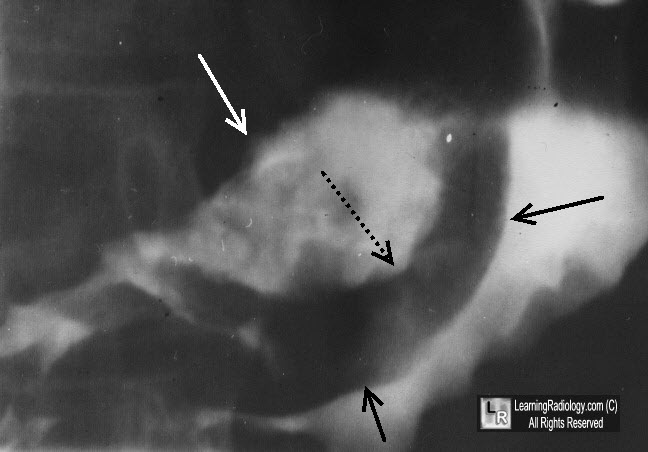 Welcome to LearningRadiology - radiology, radiologic, imaging, signs ...
