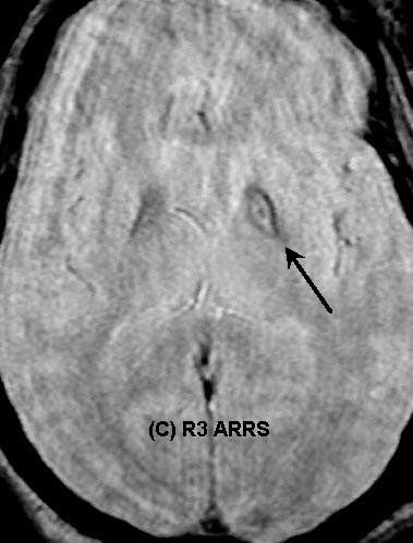 Welcome to LearningRadiology - radiology, radiologic, imaging, signs ...