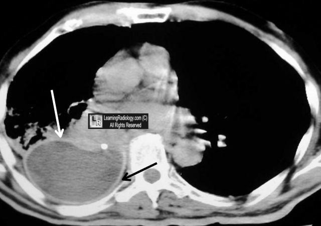 Welcome to LearningRadiology - radiology signs, imaging, radiologic ...