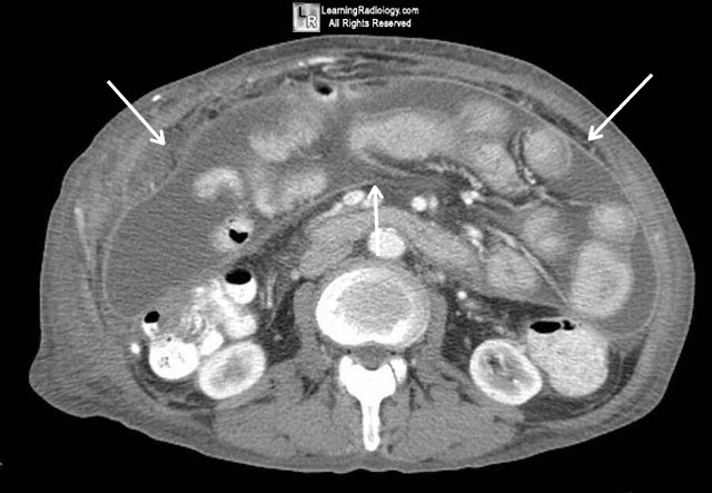 sclerosing peritonitis - meddic