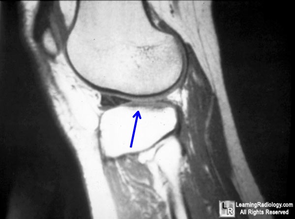 Welcome to LearningRadiology - radiology, radiologic, imaging, signs ...