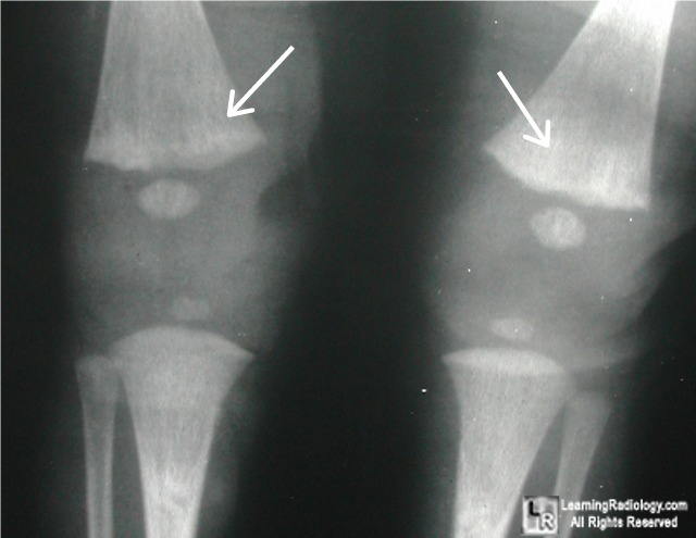 Welcome to LearningRadiology - radiology, radiologic, imaging, signs ...