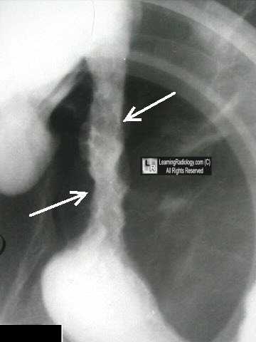 Welcome to LearningRadiology - radiology, radiologic, imaging, signs ...